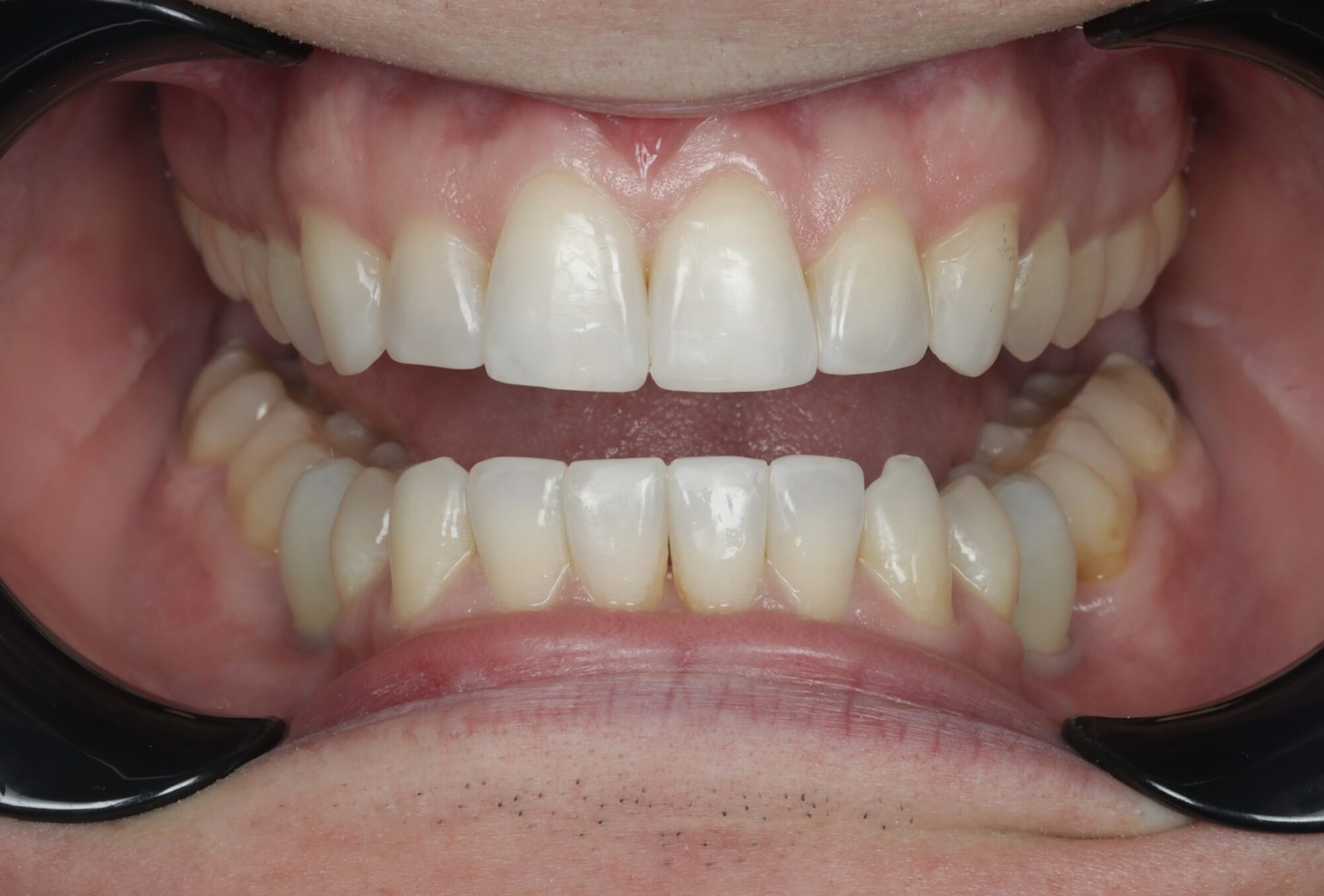 Invisalign Treatment & Straightening | Beyond Dental