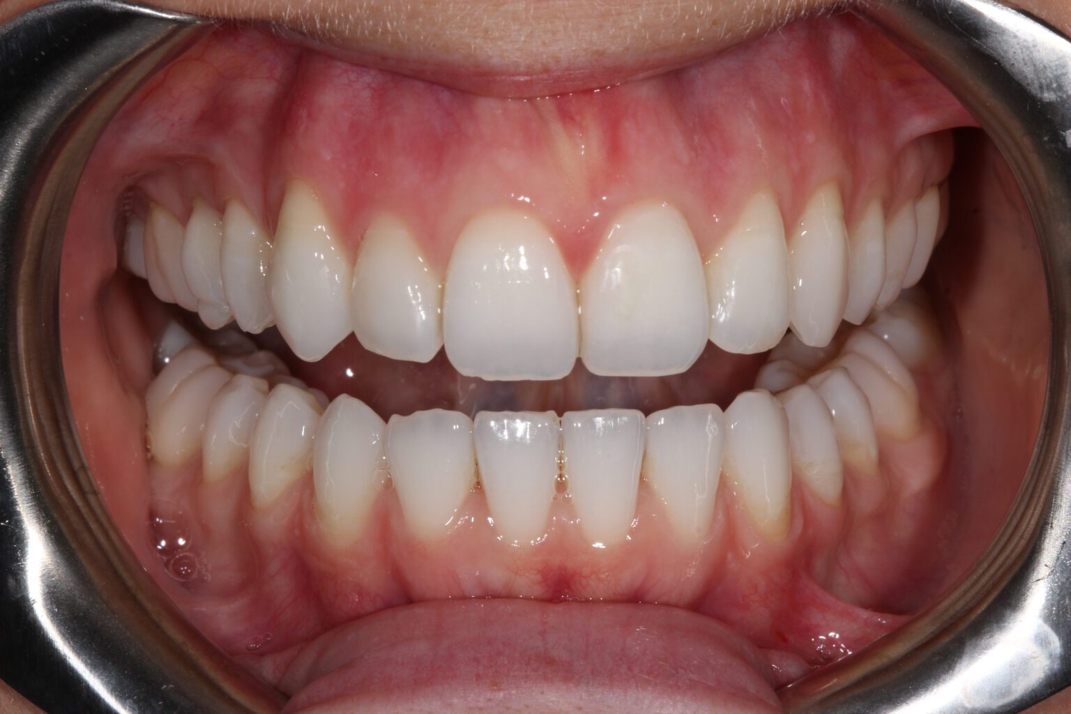 Adult Orthodontics & Teeth Straightening | Beyond Dental