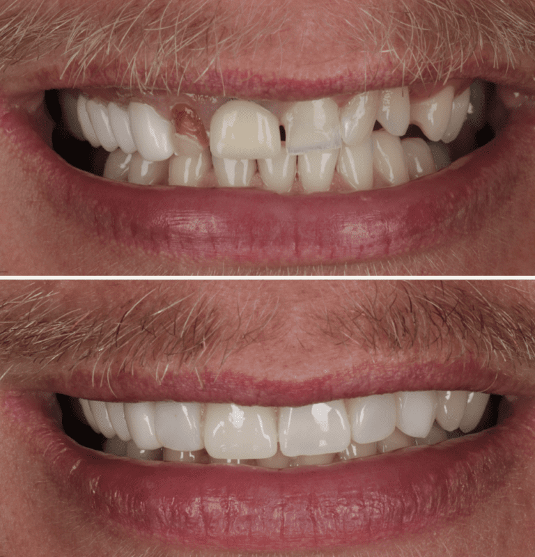 Composite Bonding in Solihull | Beyond Dental