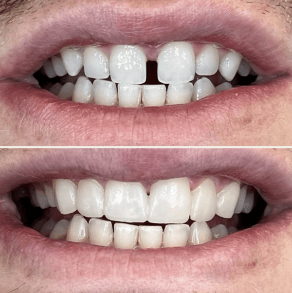 Learn About Our Dental Composite Bonding | Beyond Dental