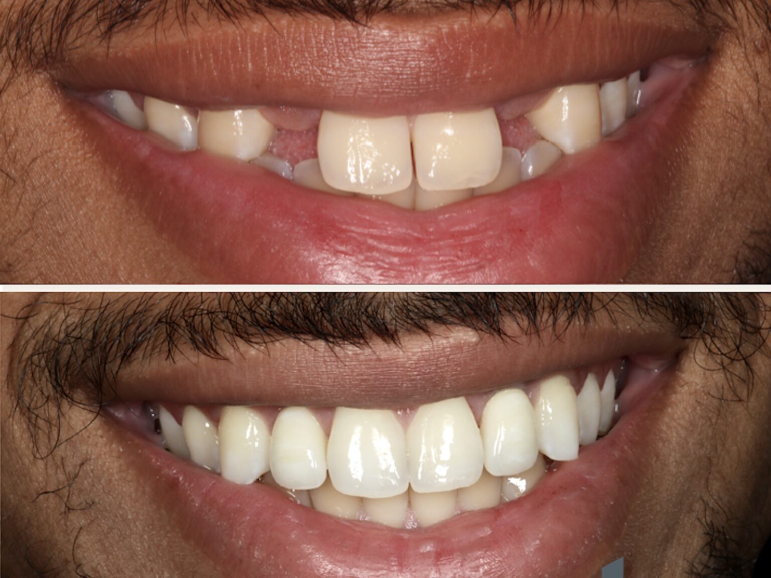 Dental Implants in Solihull | Beyond Dental